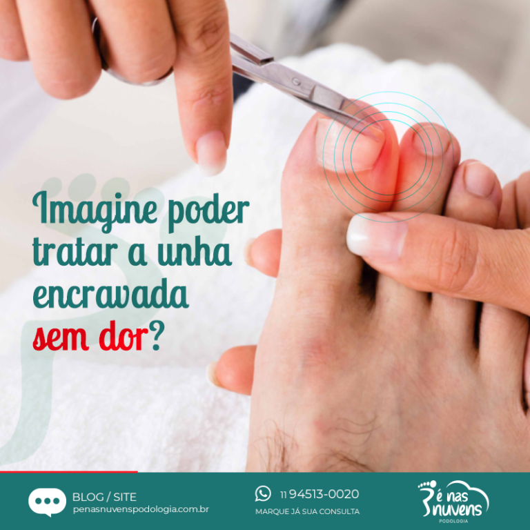 Unha encravada - Trate sem dor! - Pé Demais Podologia